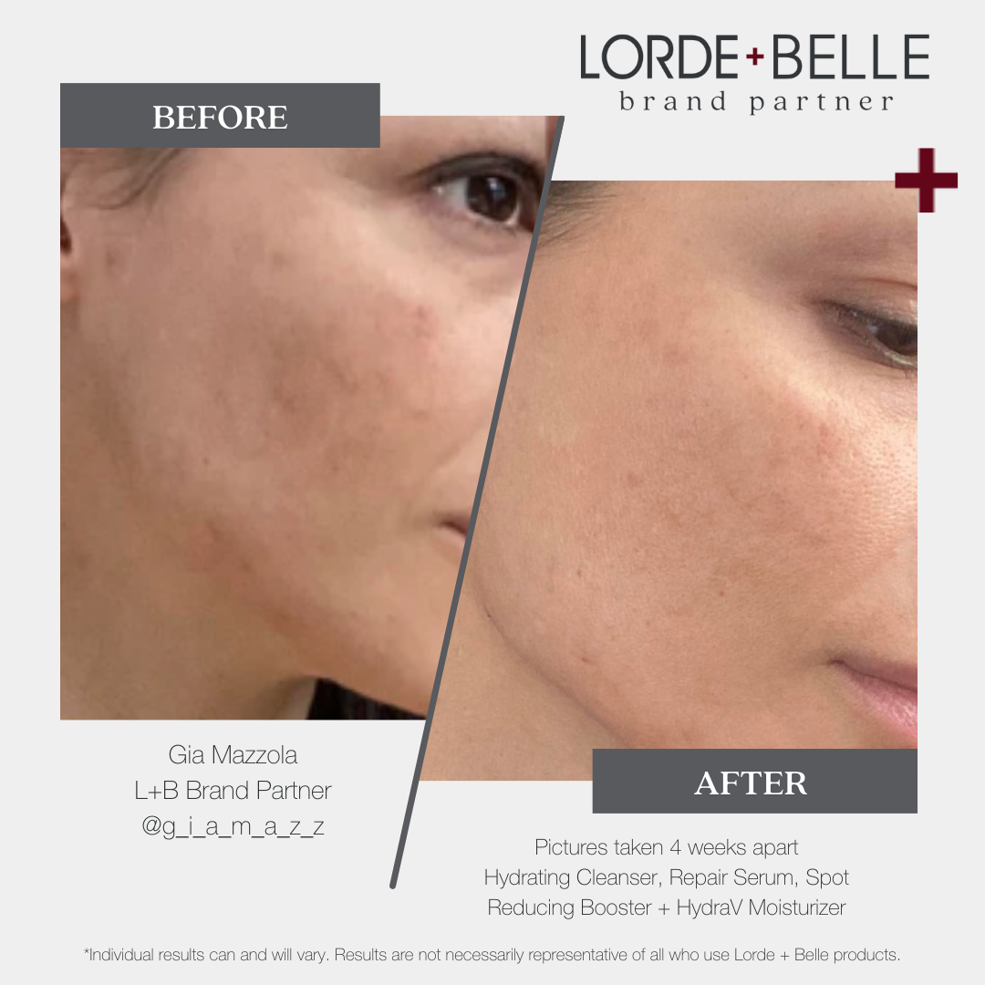 Understanding the Difference: Melasma vs. Hyperpigmentation – LORDE AND ...